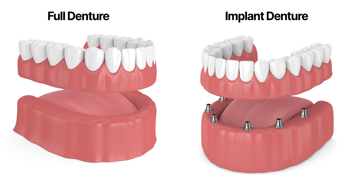 Denture | Bing Dental